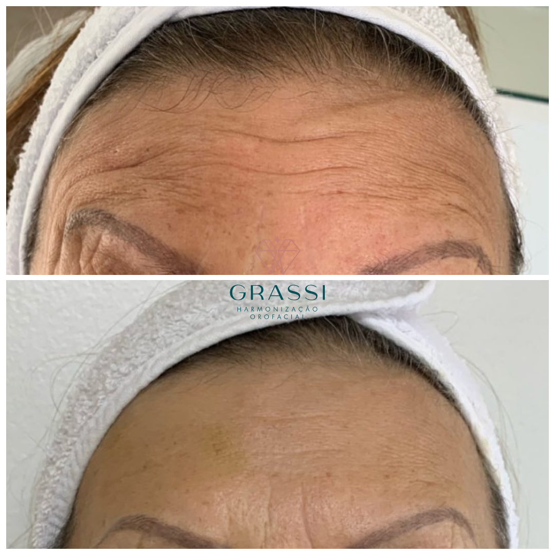 Botox - Dra. Rosalia Grassi - Agende sua avaliação